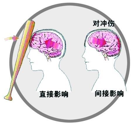 脑外伤是怎样造成的 妙手医生